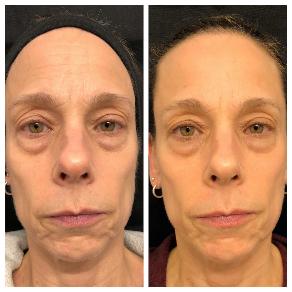 Cosmetic Acupuncture and ATP Facial Rejuvenation - Inner Light Wellness ...